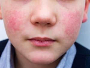 Vijfde ziekte bij kinderen: symptomen en zorgtips