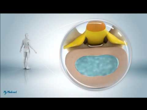 Ik heb een hernia in de rug - DokterPatient